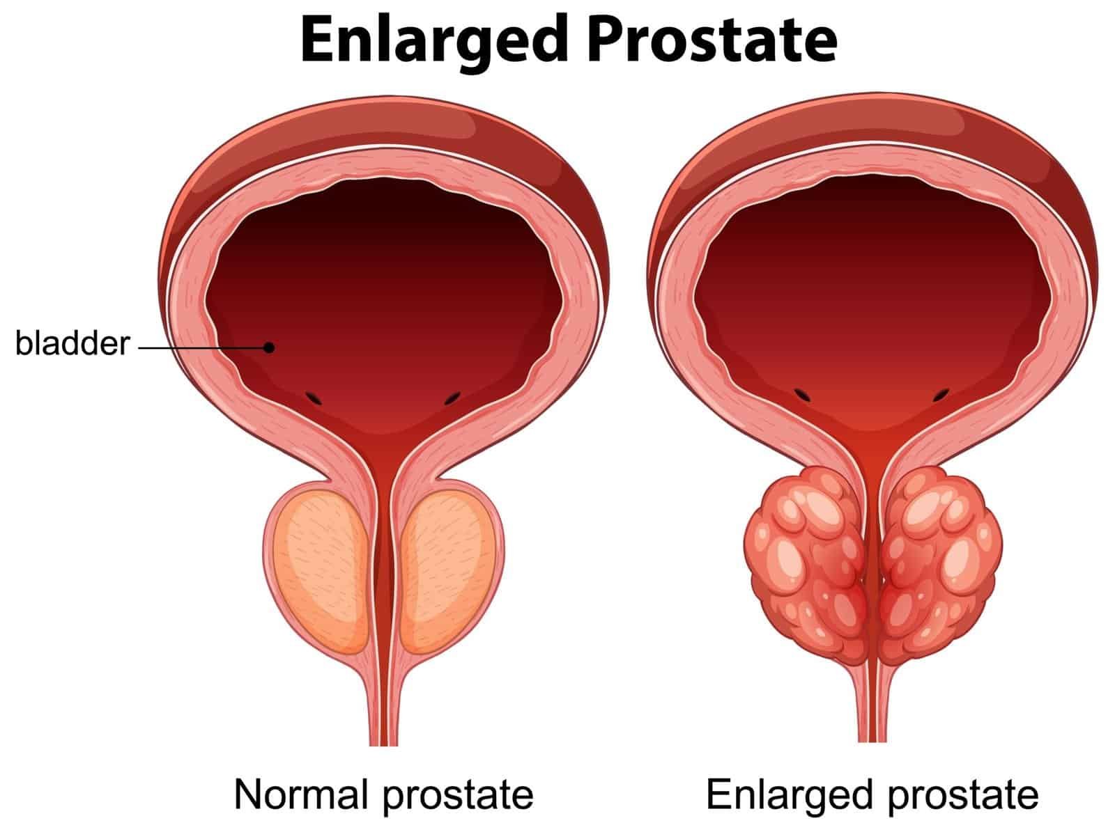 A Complete Guide to Prostatic Artery Embolization Side Effects - London ...